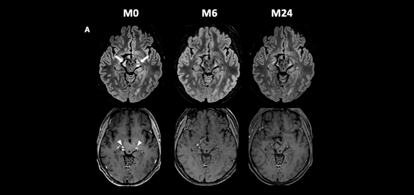 Leukodystrophies | Paris Brain Institute