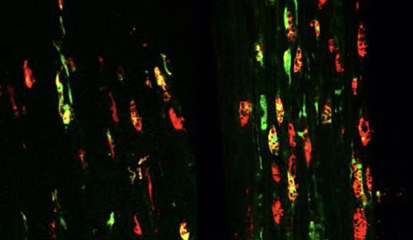 Charcot’s disease or amyotrophic lateral sclerosis (ALS) | Paris Brain ... Charcot’s disease or amyotrophic lateral sclerosis (ALS) | Paris Brain ...