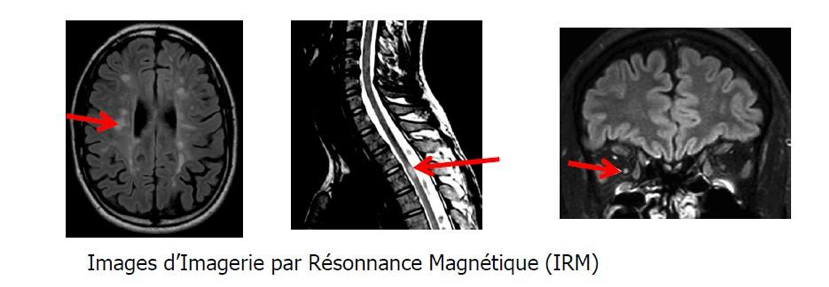 What are the biological mechanisms of multiple sclerosis (MS)? | Paris ...