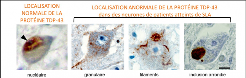 What are the biological mechanisms of Charcot’s disease? | Paris Brain ...