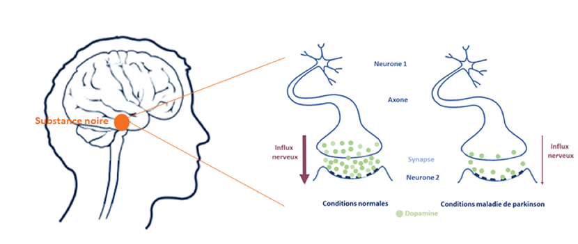 What are the biological mechanisms of Parkinson's disease? | Paris ...