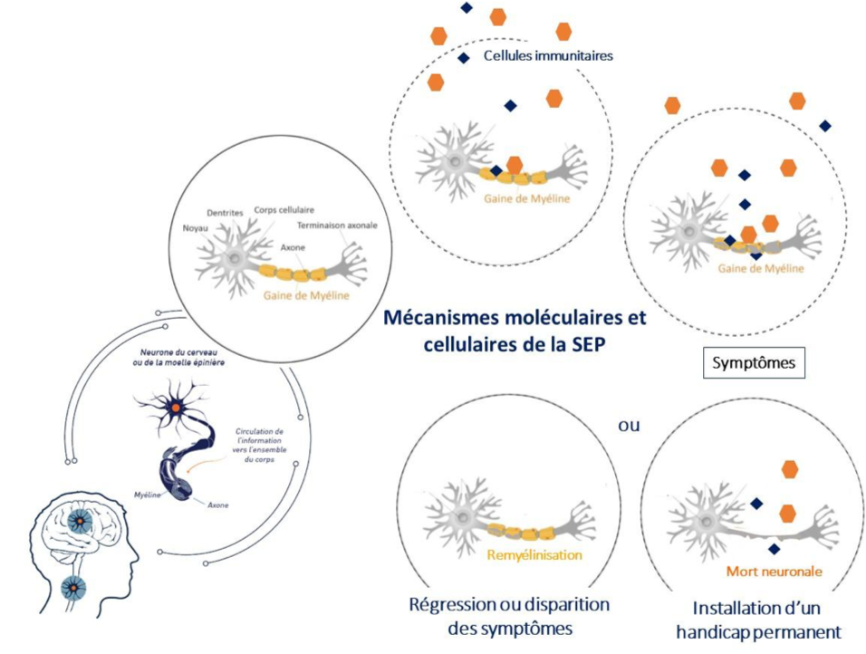 What are the biological mechanisms of multiple sclerosis (MS)? | Paris ...