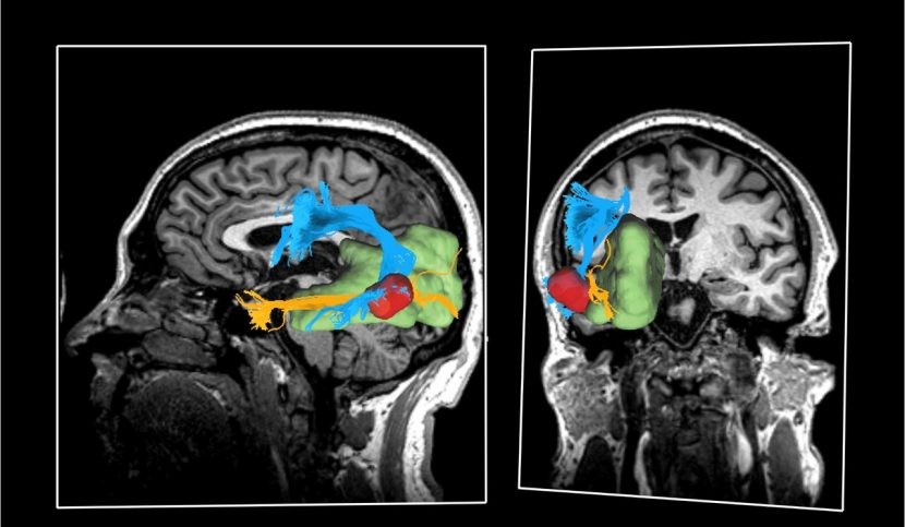 Stroke (cerebrovascular accident, CVA) | Paris Brain Institute