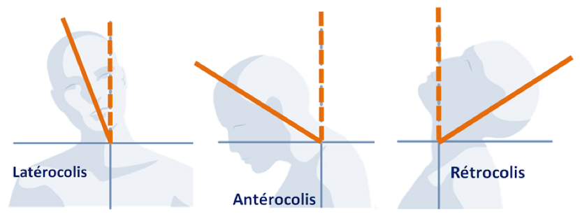 What are the Symptoms of Dystonia? | Paris Brain Institute