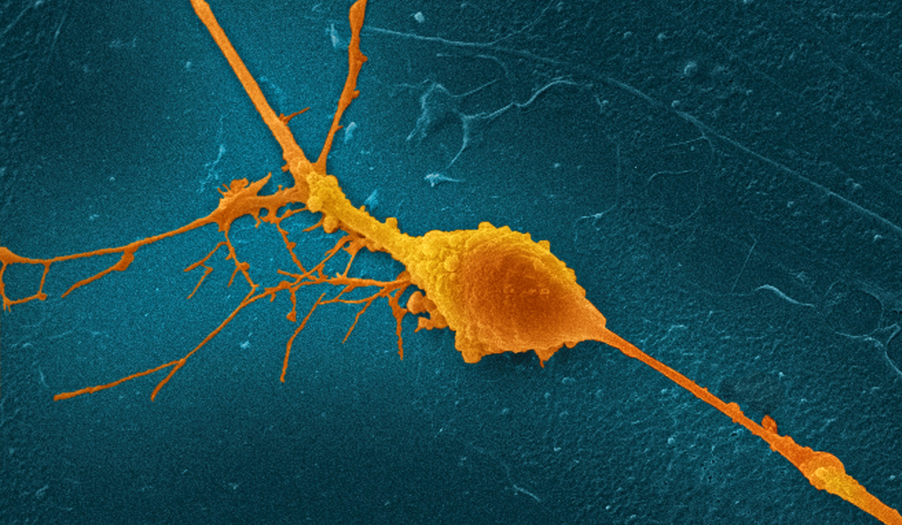 What causes multiple sclerosis? Is it hereditary? | Paris Brain Institute