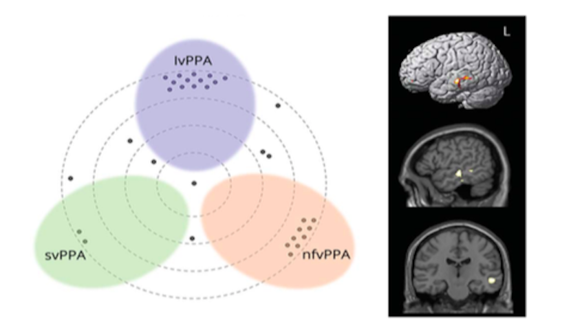 Primary Progressive Aphasia Associated With GRN Mutations: New Insights ...