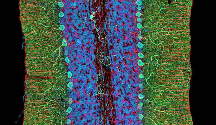 Telangiectatic ataxia | Paris Brain Institute
