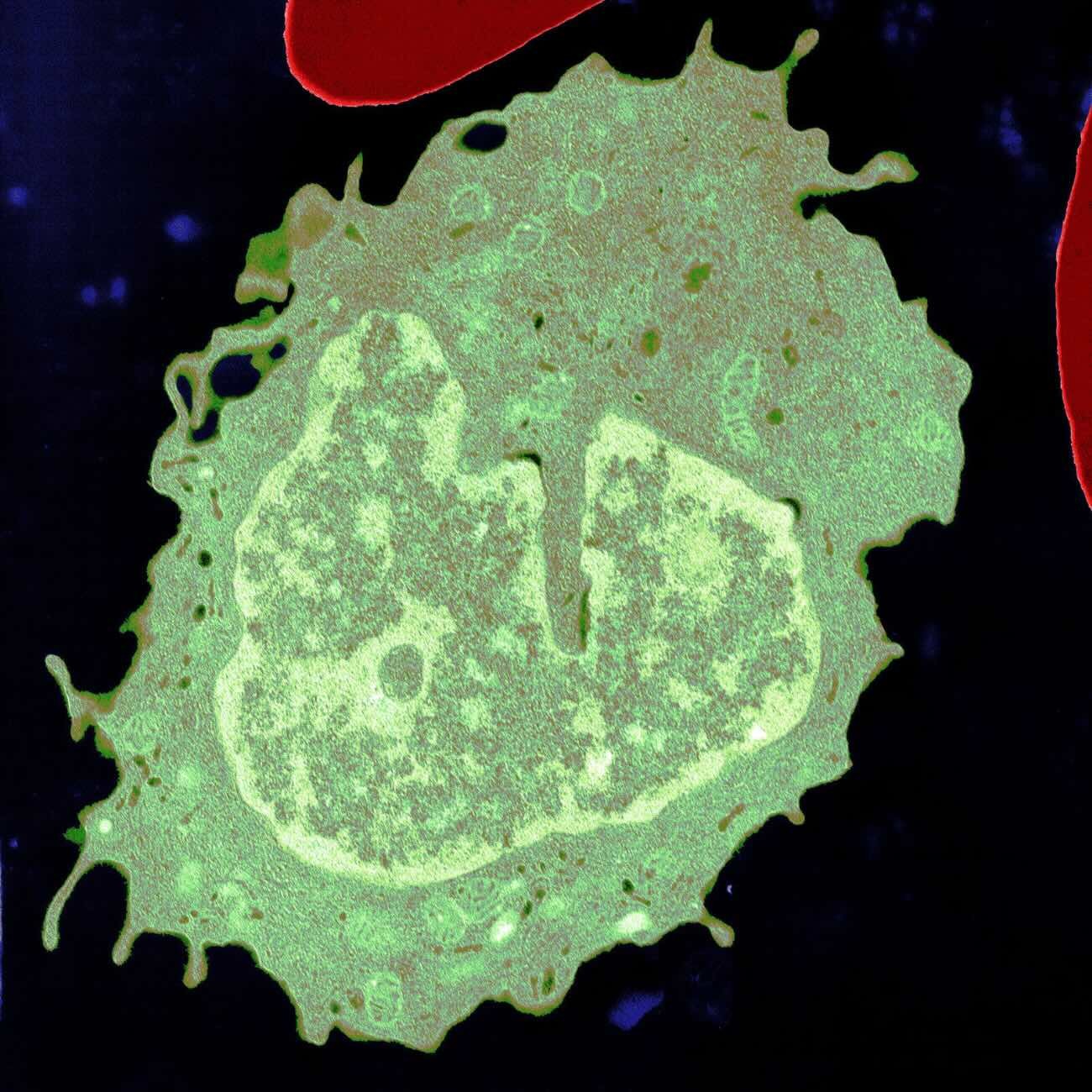 What causes multiple sclerosis? Is it hereditary? | Paris Brain Institute