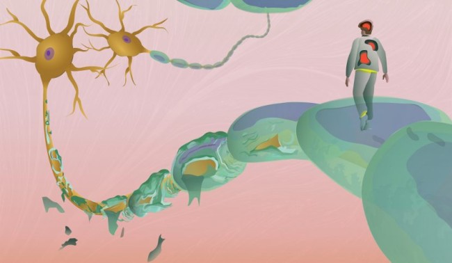 What causes multiple sclerosis? Is it hereditary? | Paris Brain Institute