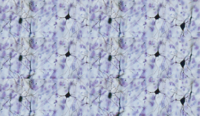 What are the major differences between PSP and Parkinson’s disease ...