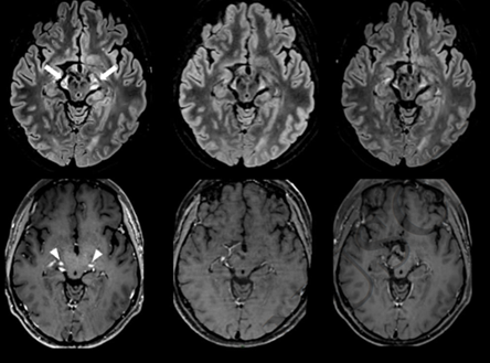 Leukodystrophies | Paris Brain Institute