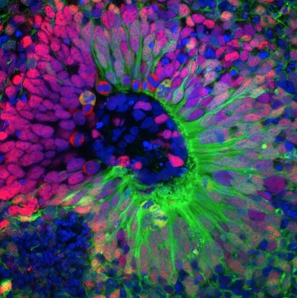Origin of Lance-Adams Syndrome Finally Elucidated | Paris Brain Institute