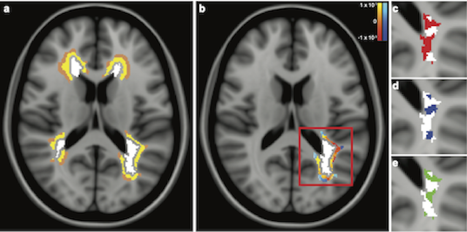 First Demonstration Of The Neuroprotective Effect Of Remyelination In Multiple Sclerosis